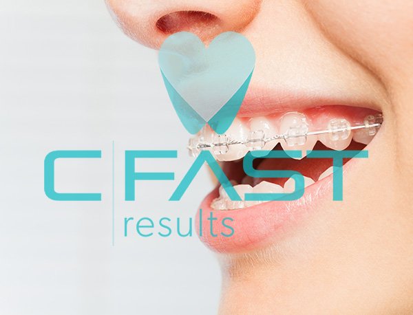 Cfast Teeth Straightening | Inchvannie House Dental Practice